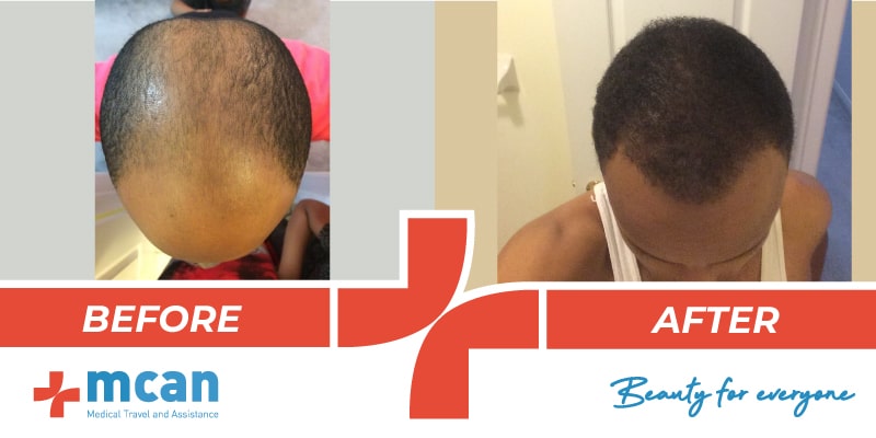 Hair Transplantation Before And After Mcan Health
