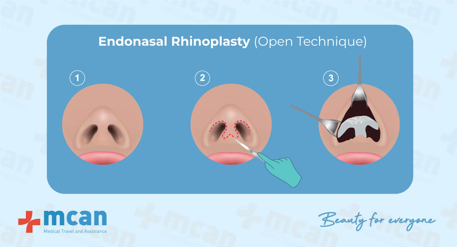 Nose Job in Turkey | Rhinoplasty Turkey Cost | MCAN Health