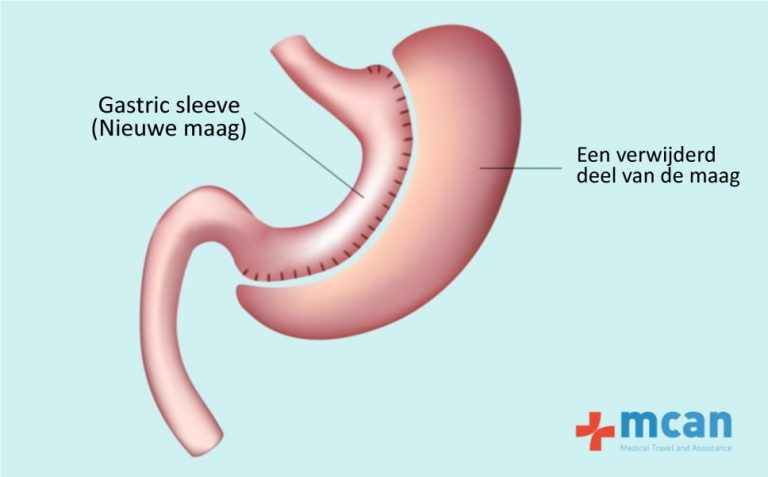 Bariatrische chirurgie in Turkije - MCAN Health
