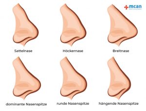 Nasen Op Türkei | Rhinoplastik | Nasenkorrektur |MCAN Health