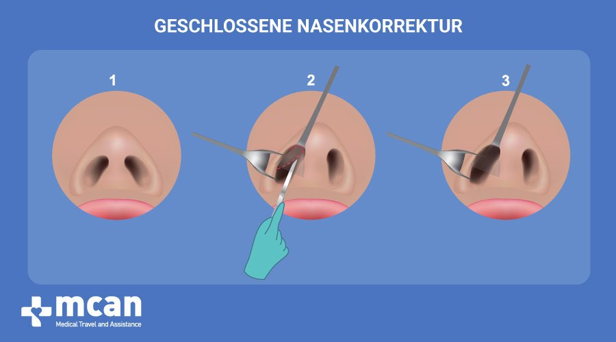 Nasen Op Türkei | Rhinoplastik | Nasenkorrektur |MCAN Health
