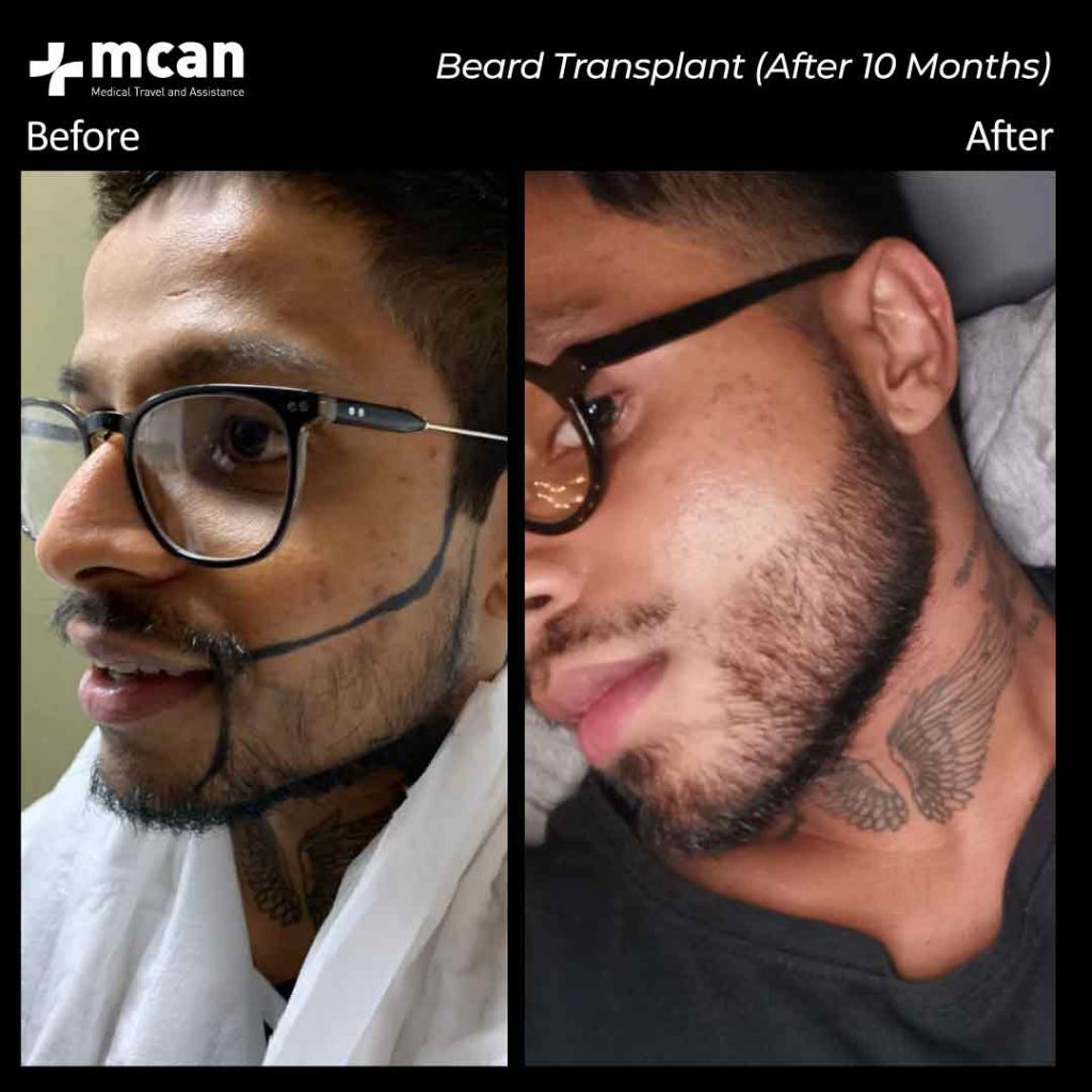 Before And After Beard Mcan Health
