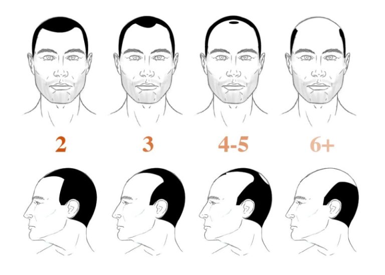 How Many Grafts Needed For A Good Hair Transplant? | MCAN Health Blog