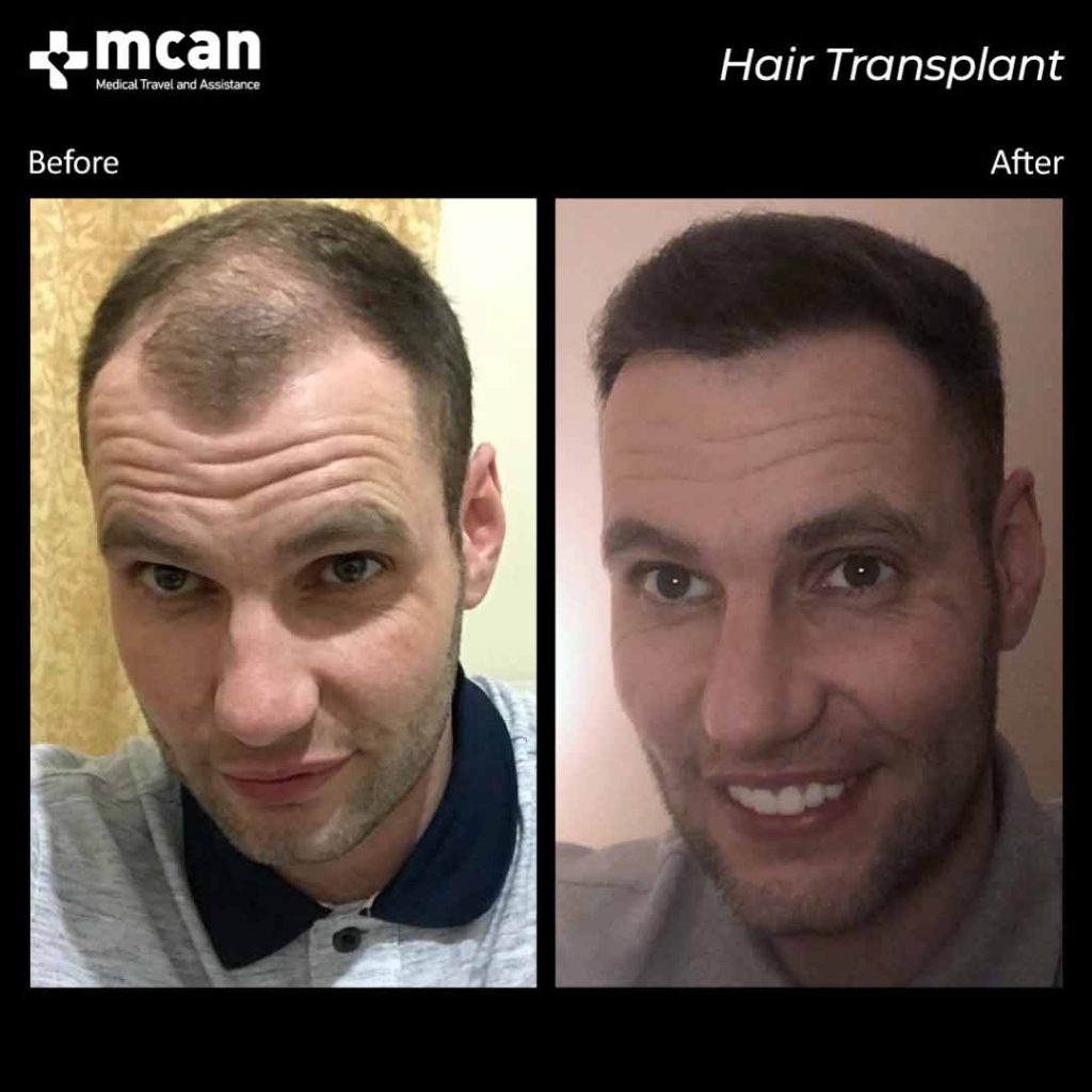 Hair Transplantation Before And After Mcan Health