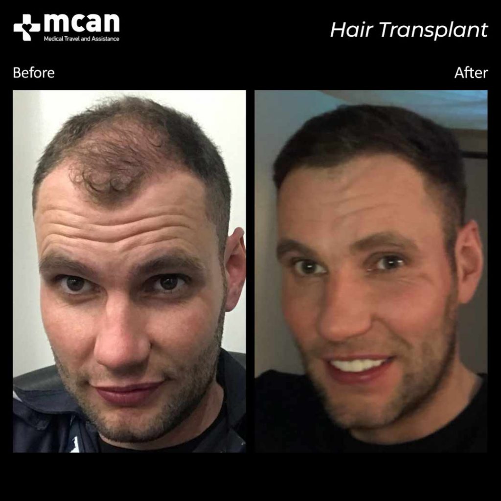 Hair Transplantation Before And After Mcan Health