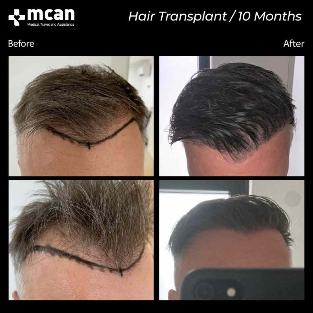 Hair Transplantation Before And After Mcan Health