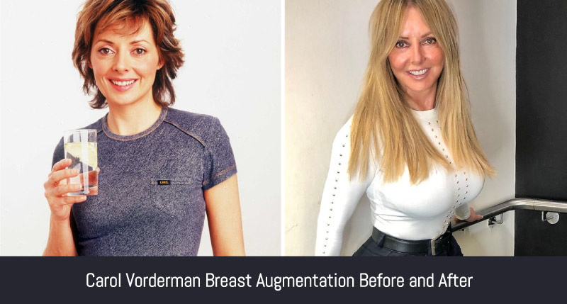 Carol Vorderman Plastic Surgery Journey True Or False
