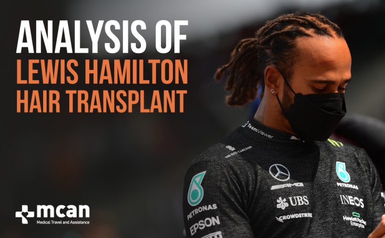 The Whole Story about Lewis Hamilton Hair Transplant!