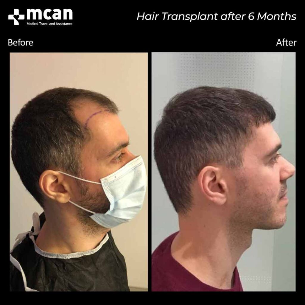 Hair Transplantation Before And After Mcan Health