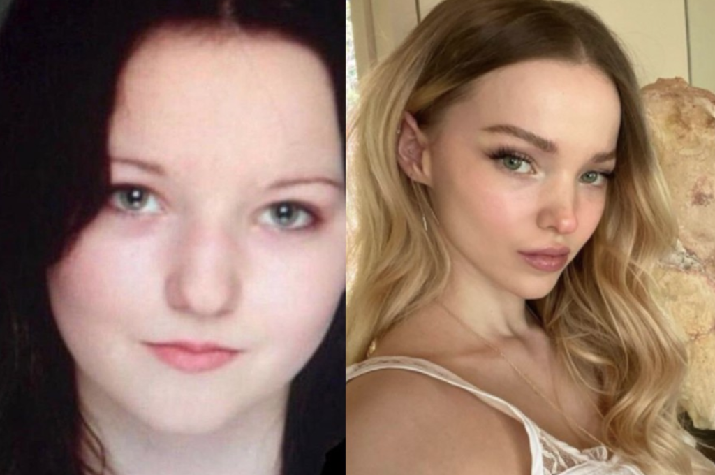 Dove Cameron Plastic Surgery + Before and After Pictures