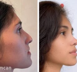 Rhinoplasty Turkey - All Inclusive Nose Job in Turkey Cost 2023