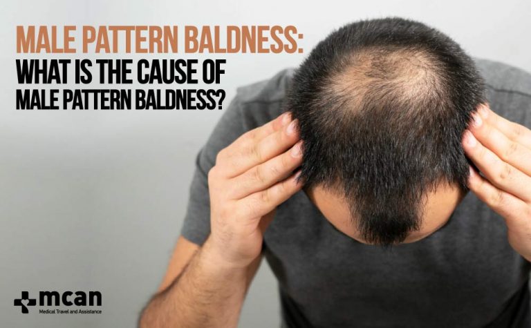 Male Pattern Baldness What Is The Cause Of Male Pattern Baldness