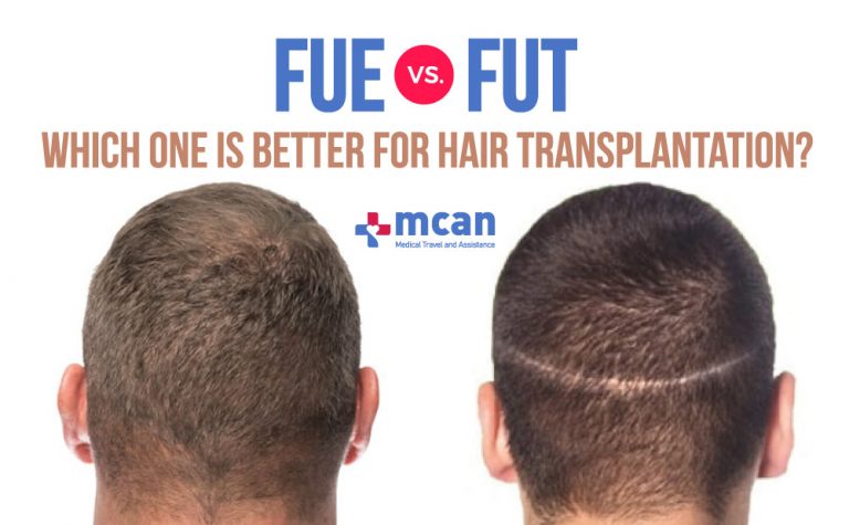 FUE vs. FUT: Which One is Better for Hair Transplantation? | MCAN ...