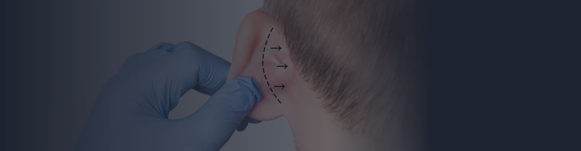 Otoplasty (Ear Correction) Turkey | MCAN Health Otoplasty (Ear Correction) Turkey | MCAN Health