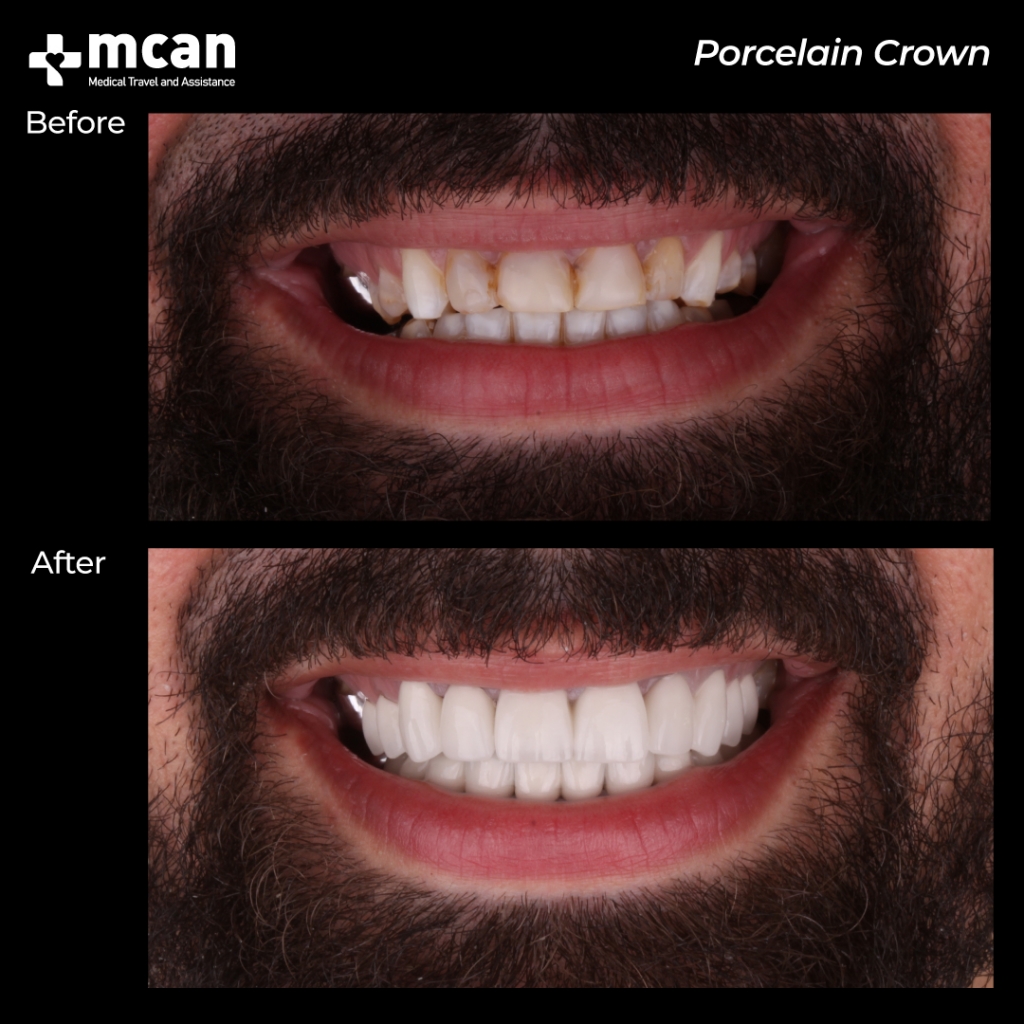 Floss Your Teeth Wisely: Everything You Need to Know about Flossing ...