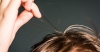 Trichotillomania (Hair Pulling Disorder) - Do You Think You Have It ...