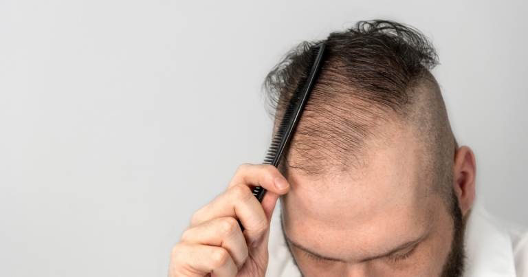 Trichotillomania (Hair Pulling Disorder) - Do You Think You Have It ...