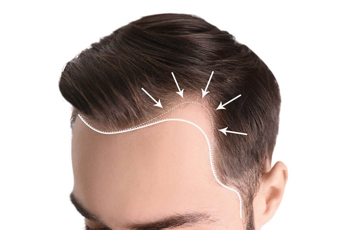 How to Stop Receding Hairline: Causes & Treatment | MCAN Health Blog