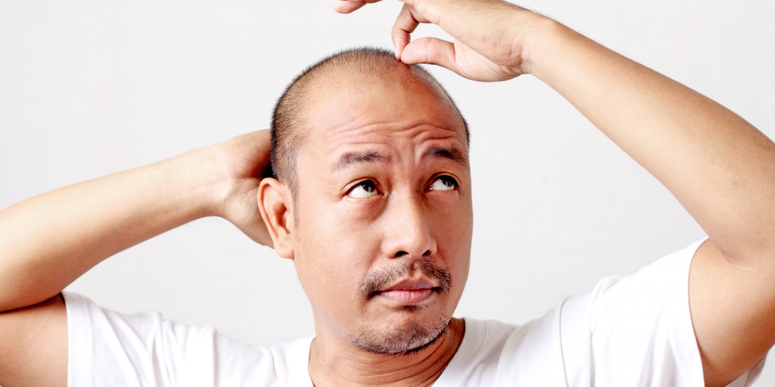 How to Stop Receding Hairline: Causes & Treatment | MCAN Health Blog