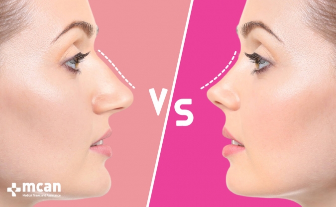 Barbie Nose vs Natural Nose Job | MCAN Health Blog