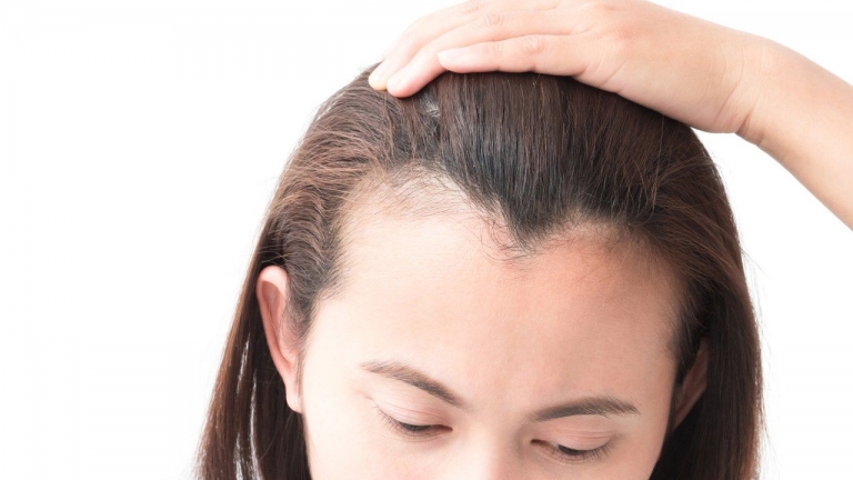 Understanding The Different Types Of Alopecia | MCAN Health Blog