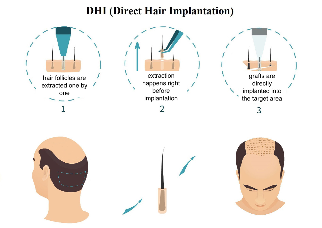 DHI vs. FUE: Hair Transplant Procedures Compared | MCAN Health Blog
