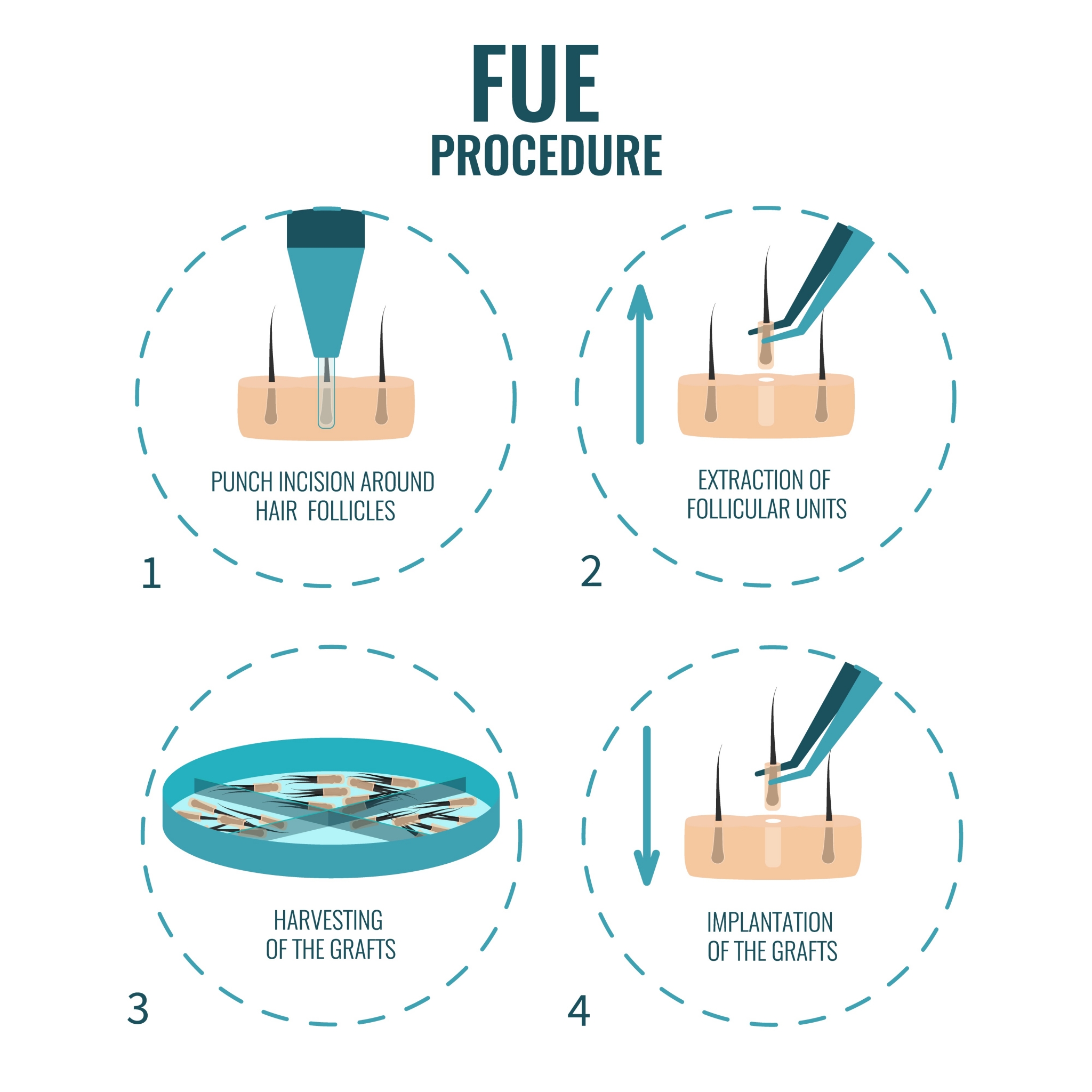 DHI vs. FUE: Hair Transplant Procedures Compared | MCAN Health Blog