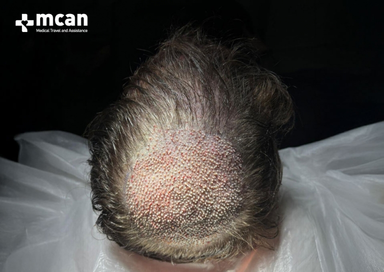 Unshaven Hair Transplant: Is It Possible to Perform Hair Transplant ...