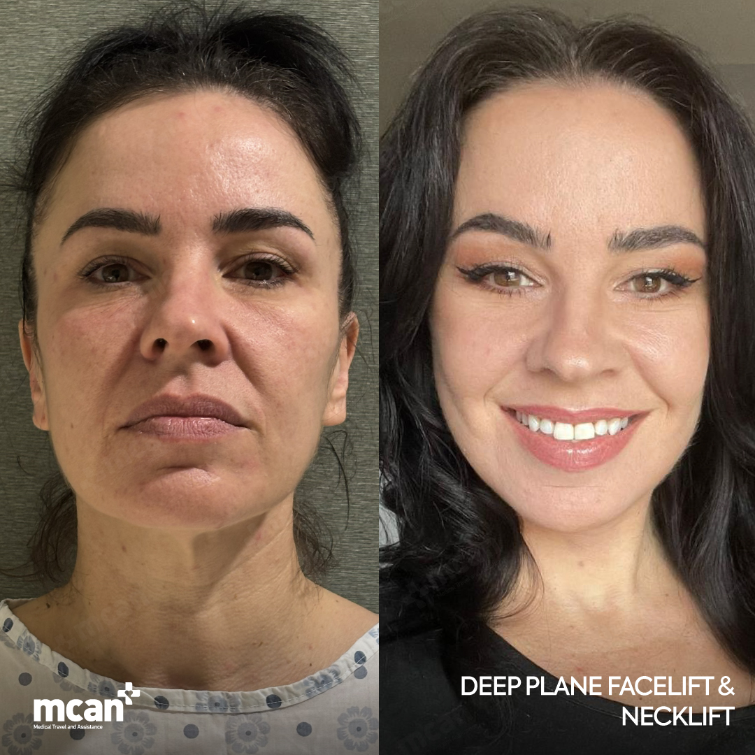 Facelift in Turkey | MCAN Health