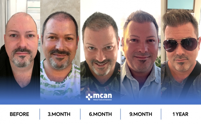 Hair Transplant Timeline: A Guide to Hair Transplant Recovery & Growth Chart | MCAN Health Blog