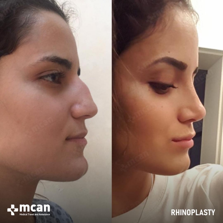Rhinoplasty Turkey | MCAN Health