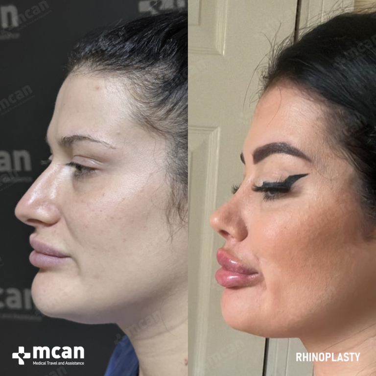 Rhinoplasty Turkey | MCAN Health