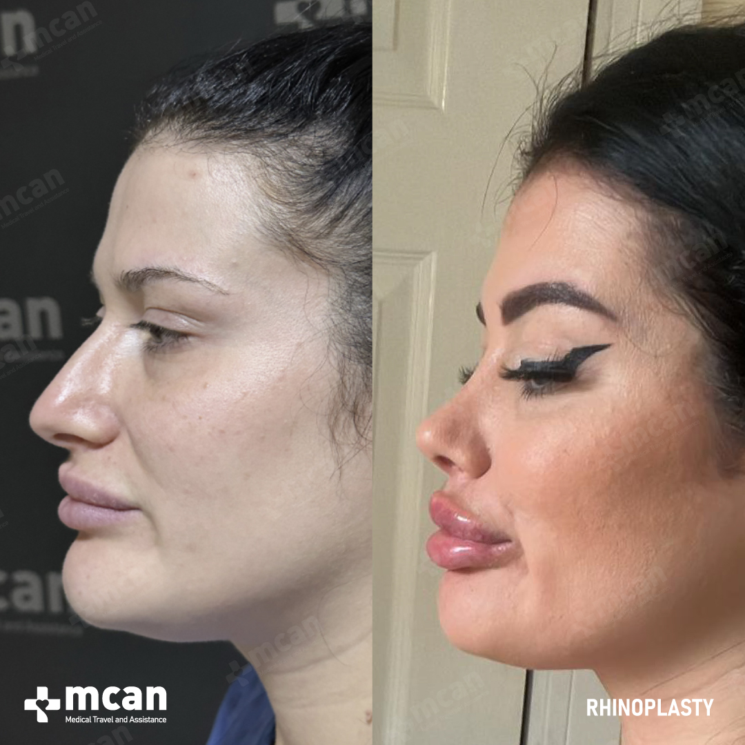 Rhinoplasty Turkey | MCAN Health