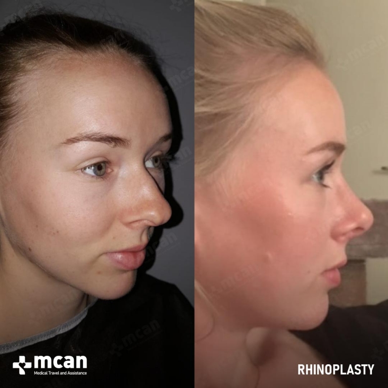 Rhinoplasty Turkey | MCAN Health