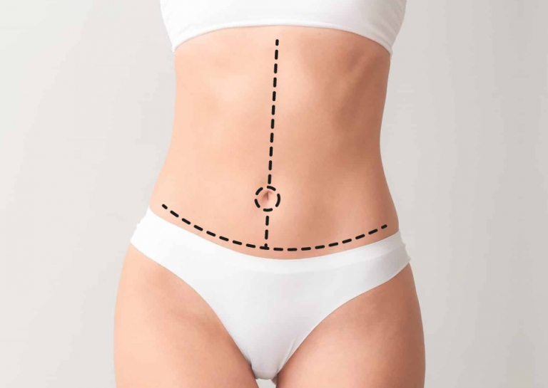 Fleur de Lis Tummy Tuck vs. Regular Tummy Tuck: Which One Is Right for You? | MCAN Health Blog
