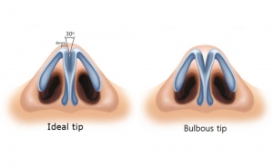 Thick Skin Rhinoplasty: A Structural Approach to Bulbous and Thick ...