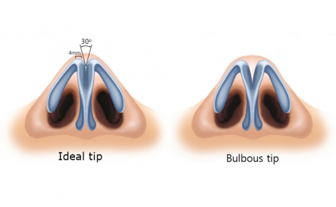 Thick Skin Rhinoplasty: A Structural Approach to Bulbous and Thick ...