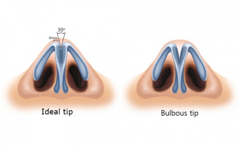 Thick Skin Rhinoplasty: A Structural Approach to Bulbous and Thick ...