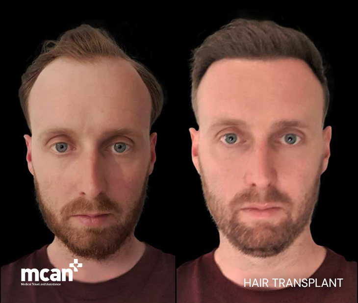 Hair Transplant Donor Area: Why It’s Critical for Natural and Lasting ...