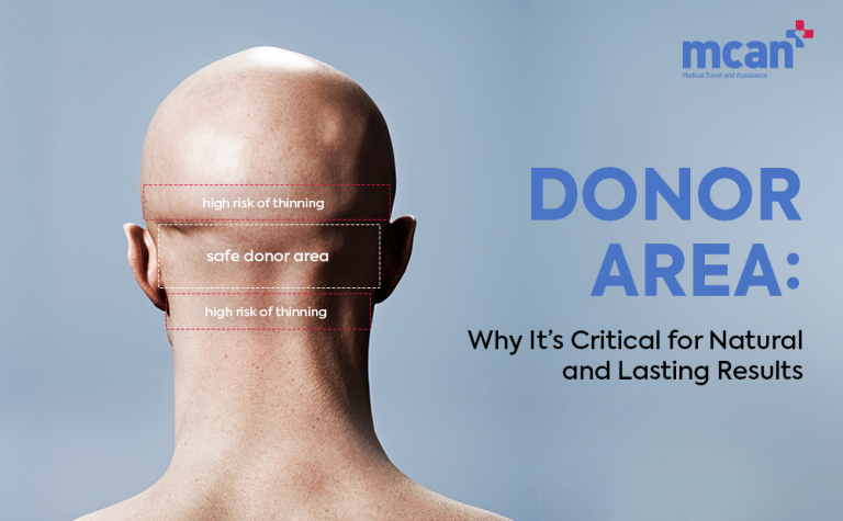 Hair Transplant Donor Area: Why It’s Critical for Natural and Lasting ...