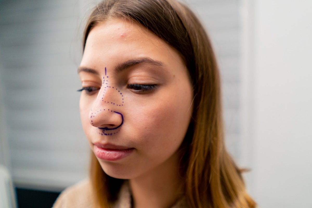 What Is Revision Rhinoplasty? When and Why a Second Nose Job Is Needed ...