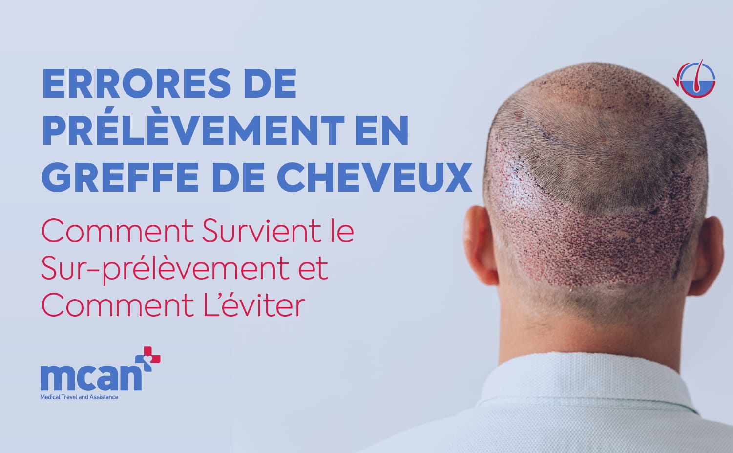 Errores de prélèvement en greffe de cheveux : comment survient le sur ...